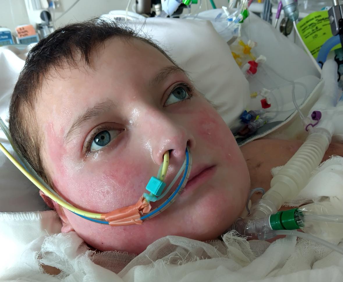 Teen boy recovering months after Saginaw gas can explosion - mlive.com