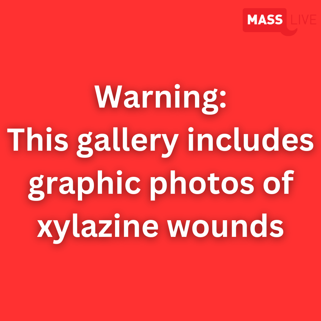 Xylazine wounds - masslive.com