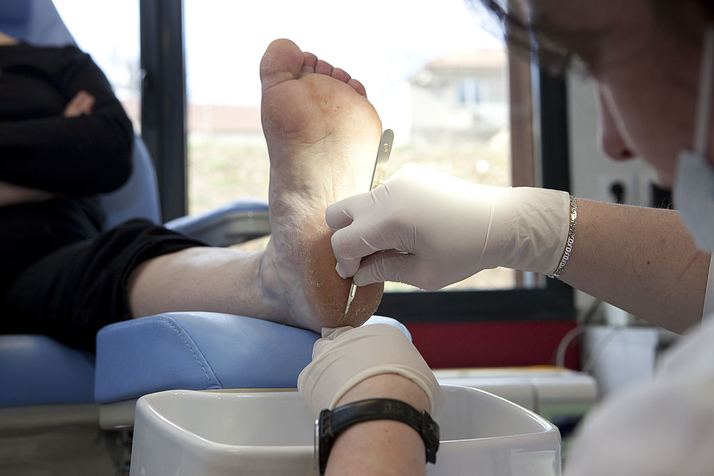 Dear Doctor: How do I get rid of foot calluses?