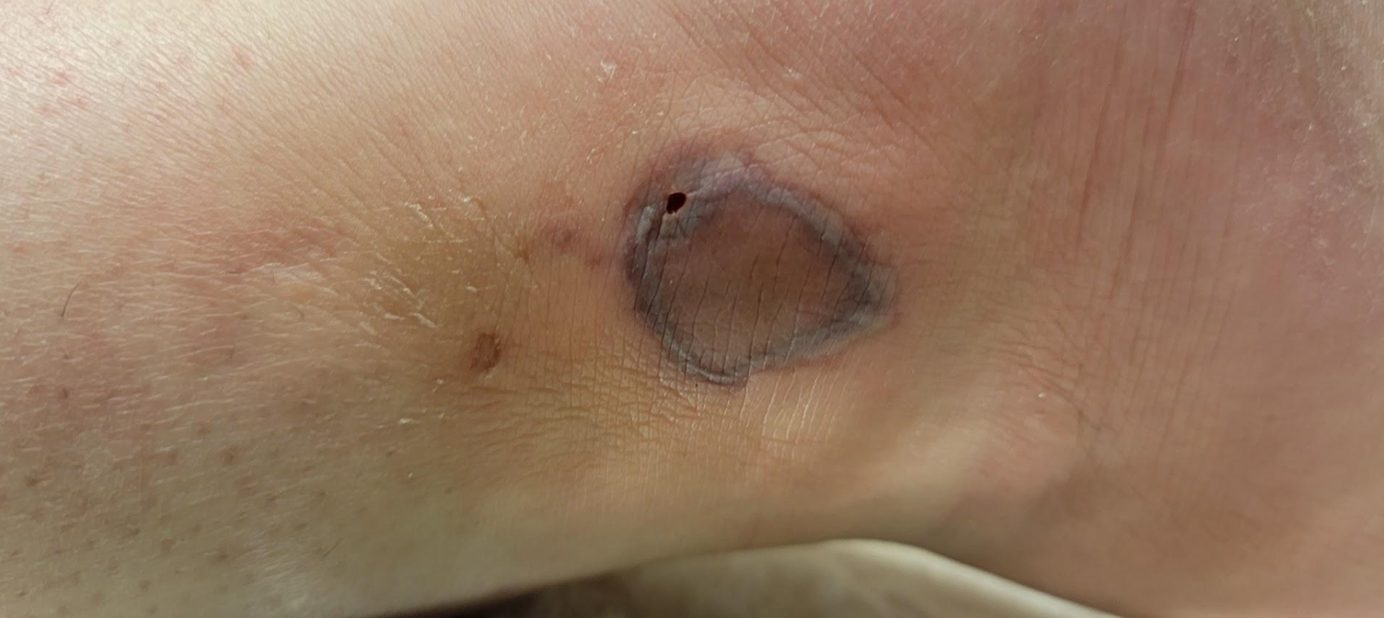 Xylazine wounds - masslive.com