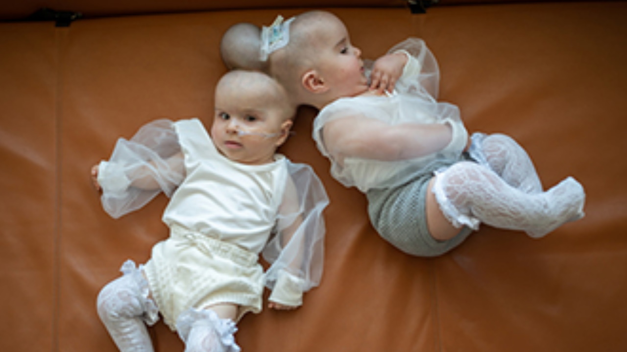 ‘Very rare anomaly’: 9-month-old twins conjoined at head successfully ...