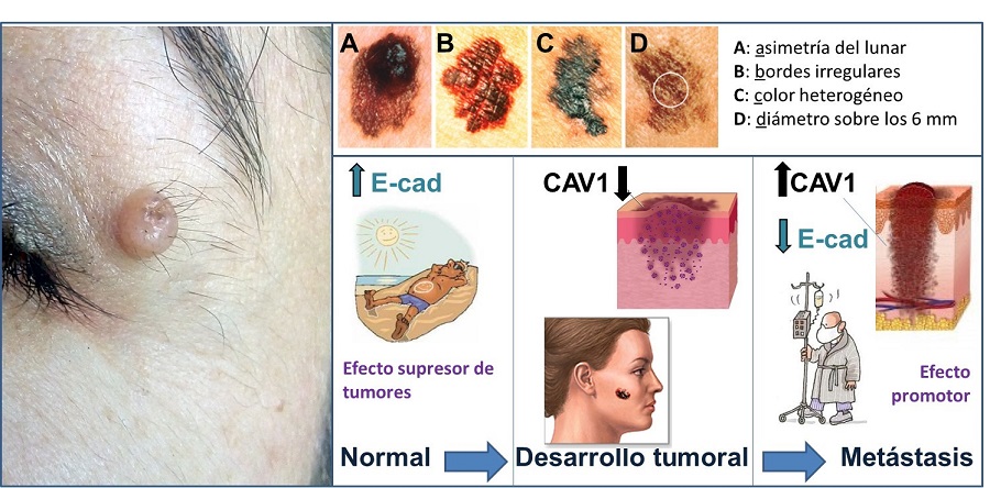 Lunares Irregulares Cáncer De Piel
