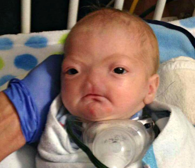 Baby born without a nose passes away; parents heartbroken