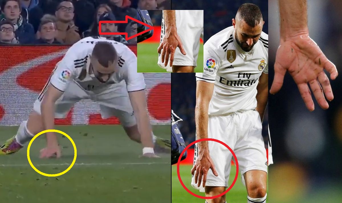 Benzema cae, se rompe dedo y queda doblado: Espeluznante lesión en el ...