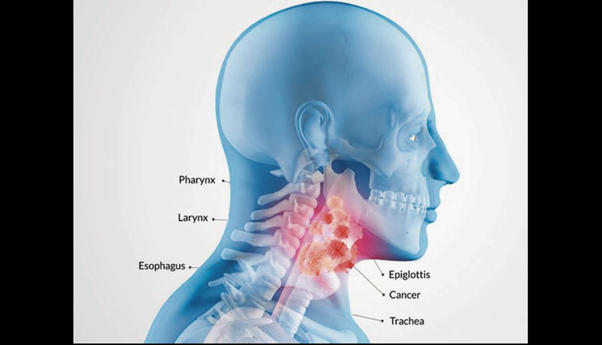 Salud: Síntomas iniciales del cáncer de garganta ¡Ten cuidado ...