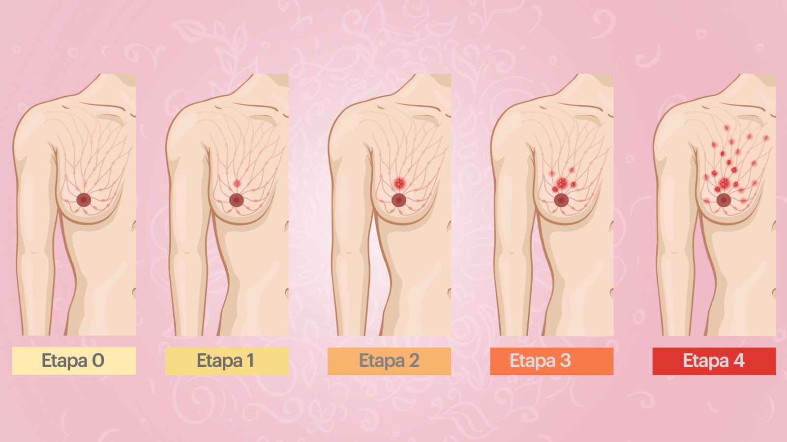 Etapas Del Cáncer De Mama SENOS LIBRES On X: "Cáncer De Mama