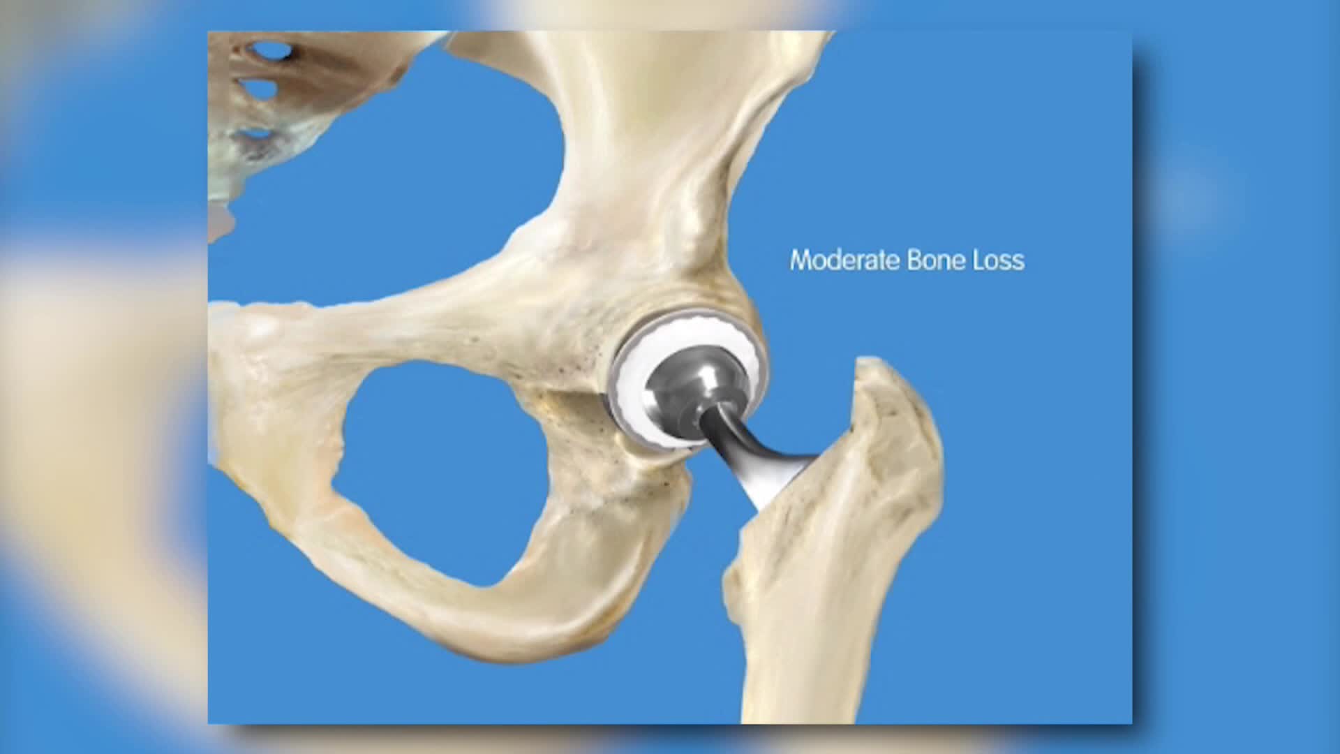 Birmingham Hip Resurfacing Complications