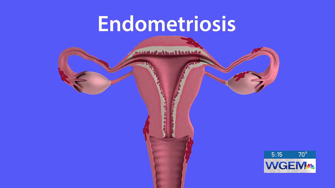 Endometriosis Prevention