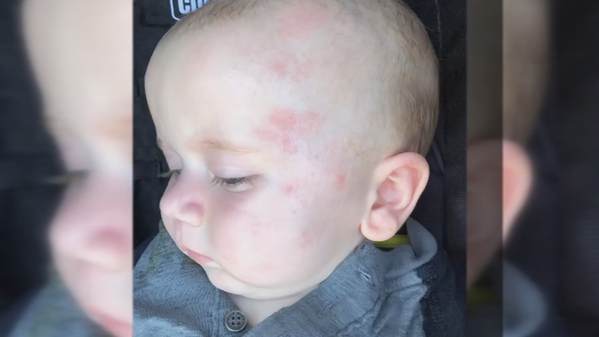 Bruised Face From Slap