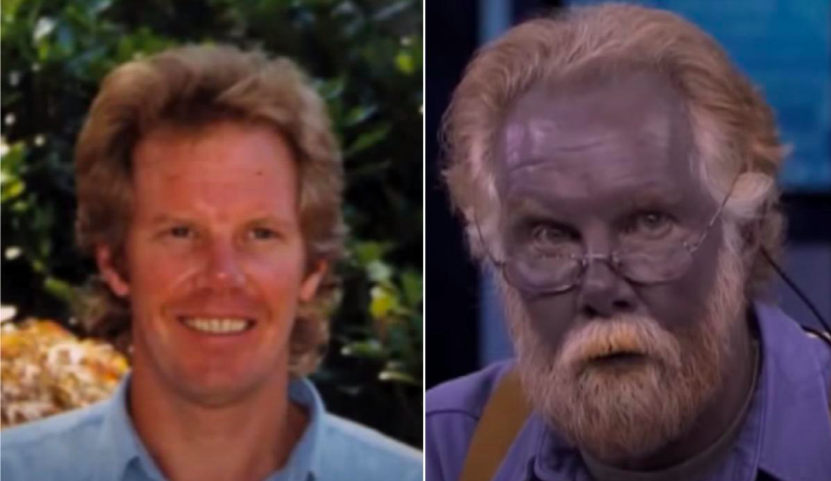 La extraña historia del hombre que se volvió azul por una enfermedad ...