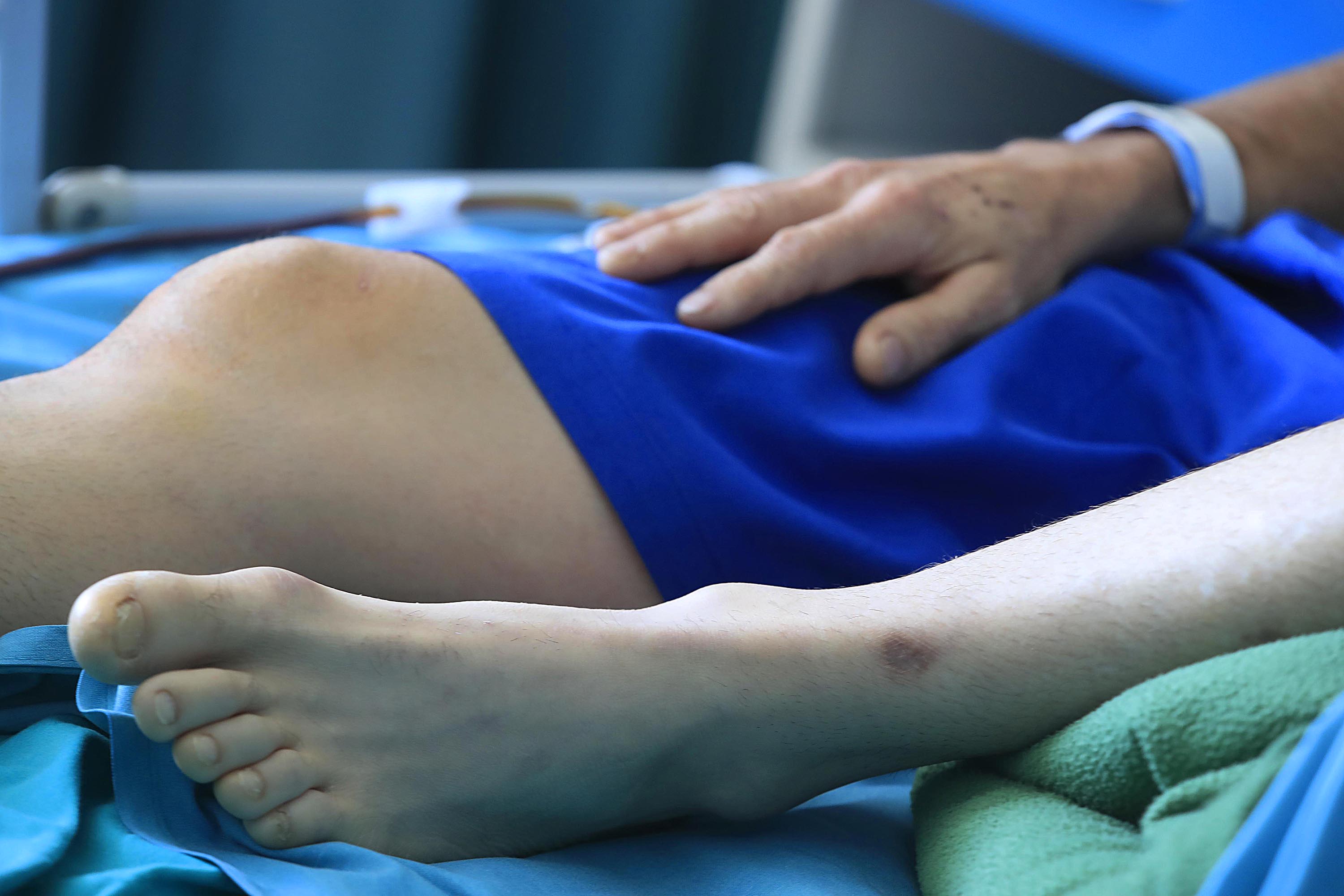 Le amputaron una pierna, pero salió peor del hospital cuando fue para ...