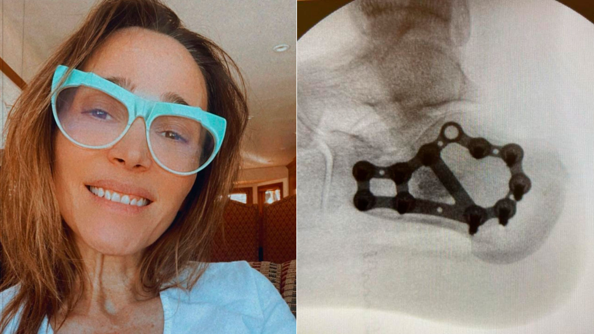 La Operación De Verónica Lozano Cómo Es La Rehabilitación De Una Cirugía En Los Talones Infobae