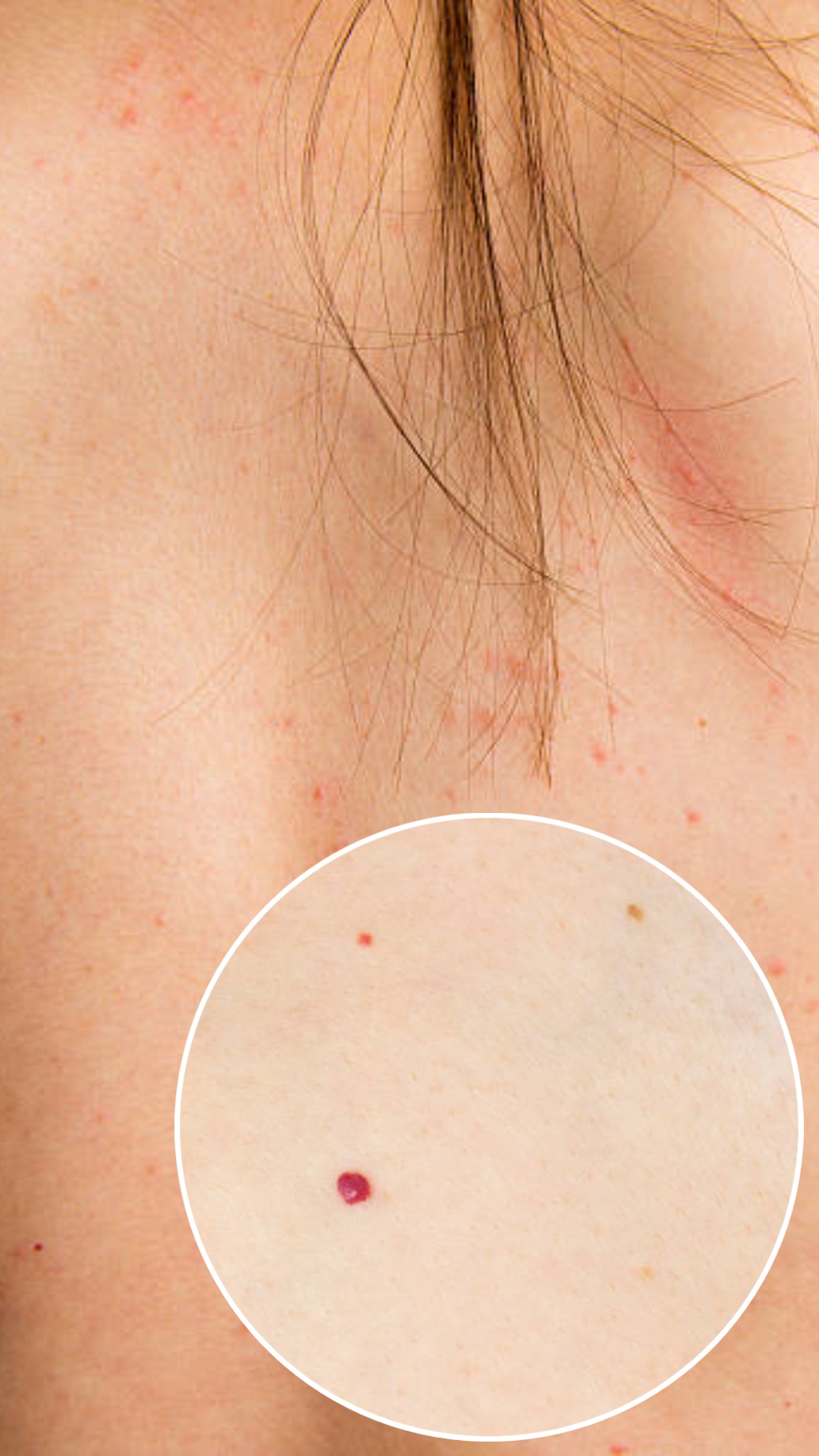 Puntos Rojos En La Piel Qué Son Los Puntos Rojos En La Piel Y Por