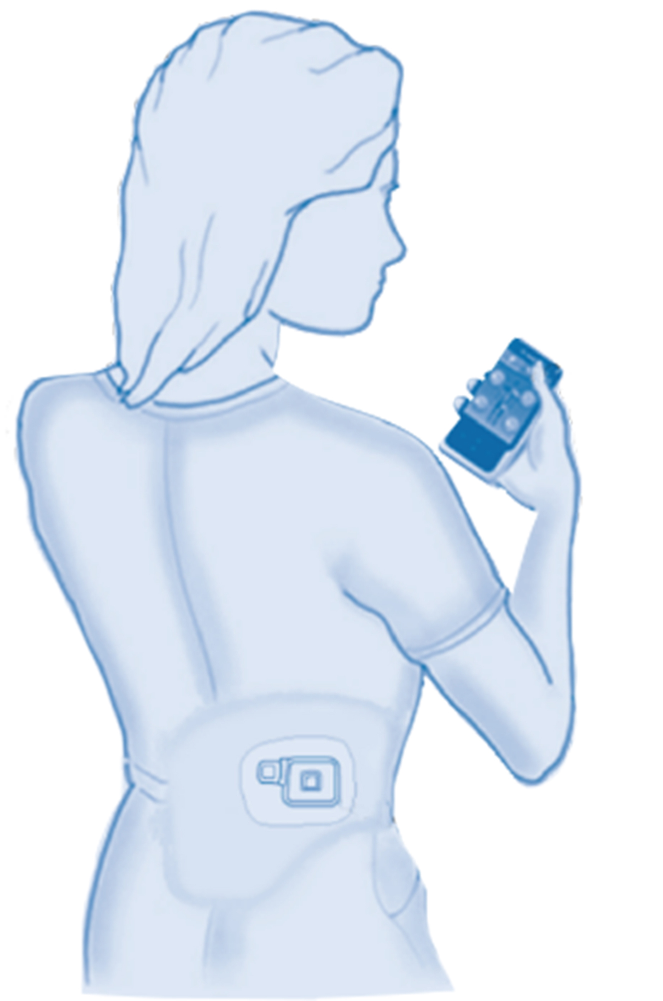 Medtronic device helps downsize the shame over incontinence