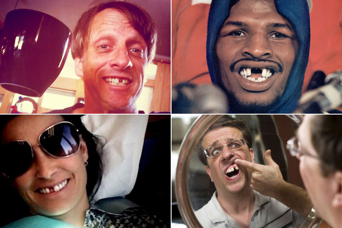 Charlie Sheen Lost Teeth