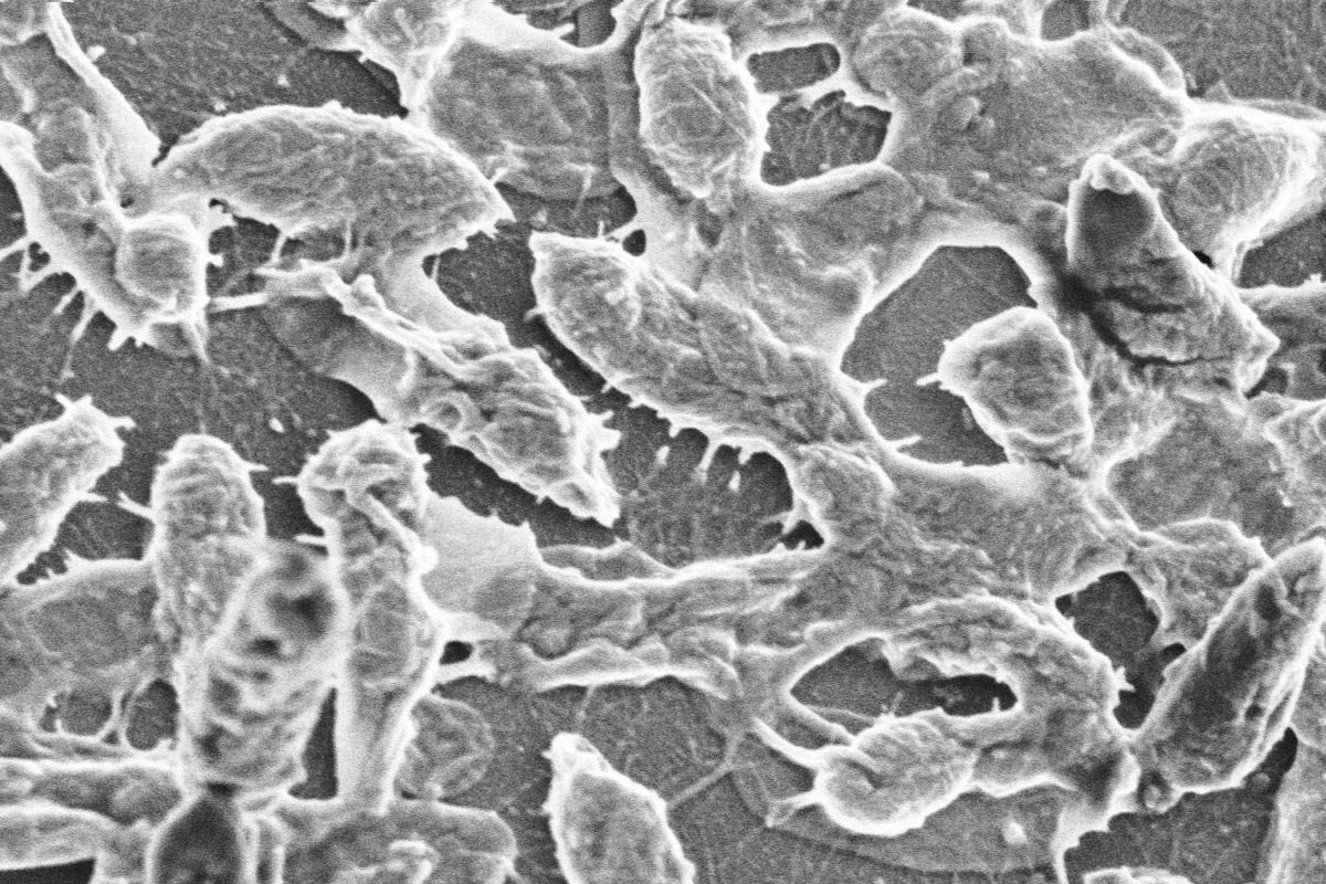 Necrotizing Fasciitis Bacteria Structure A Case Based Approach To